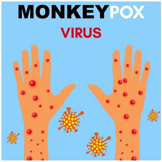 Monkeypox Virus Illustration Vector Hands Monkeypox Editorial Stock ...