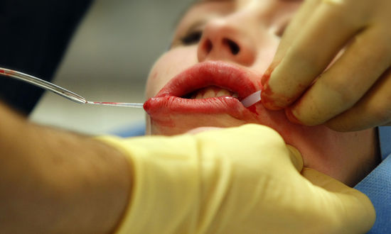 Permalip Surgery On Young Woman Her Editorial Stock Photo - Stock Image ...