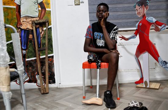 Teenager Receives Prosthetic Leg Irede Prosthetic Editorial Stock Photo ...