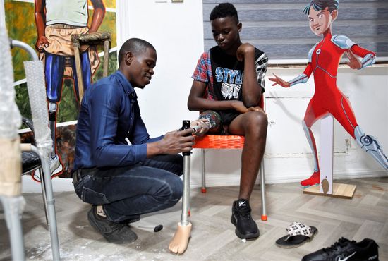 Expert Fixes Prosthetic Leg Teenager Who Editorial Stock Photo - Stock ...