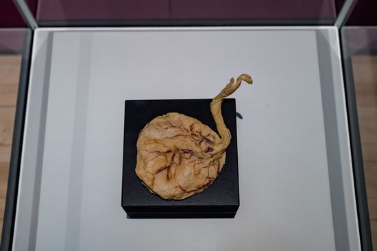 Detail Placenta Human Body Real Bodies Editorial Stock Photo - Stock ...