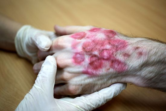 Student Seen Examining Rash On Patients Editorial Stock Photo - Stock ...