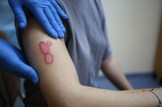 Student Seen Examining Rash On Patient Editorial Stock Photo - Stock ...