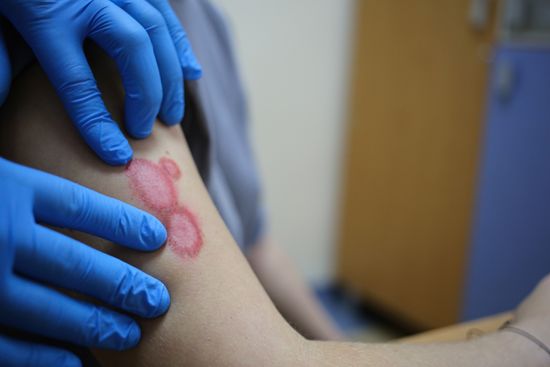 Student Seen Examining Rash On Patient Editorial Stock Photo - Stock ...