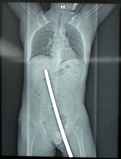 Xray Showing Bar Impaled Through Hu Editorial Stock Photo - Stock Image ...