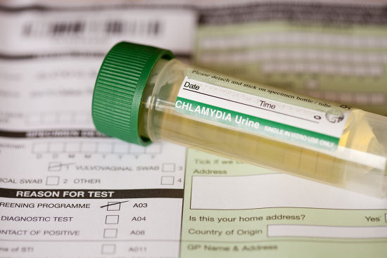 Chlamydia Self Testing Kit Uk Editorial Stock Photo - Stock Image ...