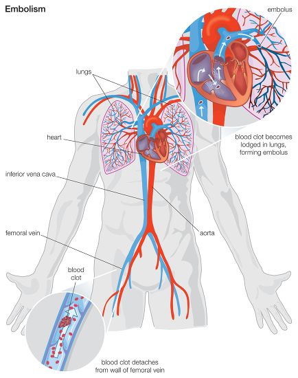 Diagram Demonstrating Progression Arterial Embolism Editorial Stock ...