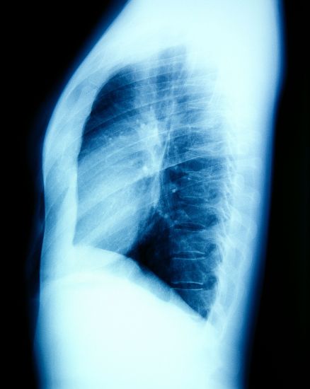 Thorax X Ray Editorial Stock Photo - Stock Image | Shutterstock