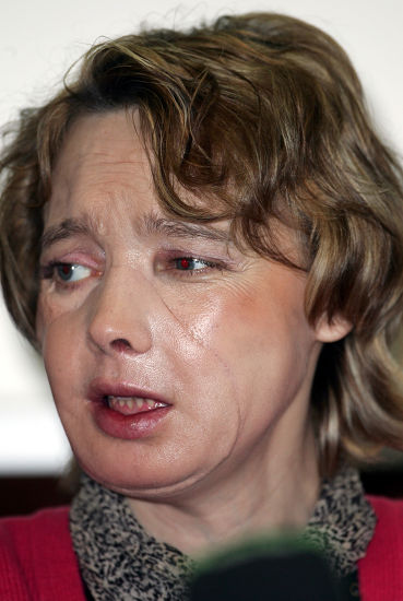 Isabelle Dinoire Woman Who Received New Editorial Stock Photo - Stock ...