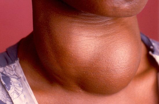 Patient Has Multinodular Goitre Swelling Neck Foto De Stock De