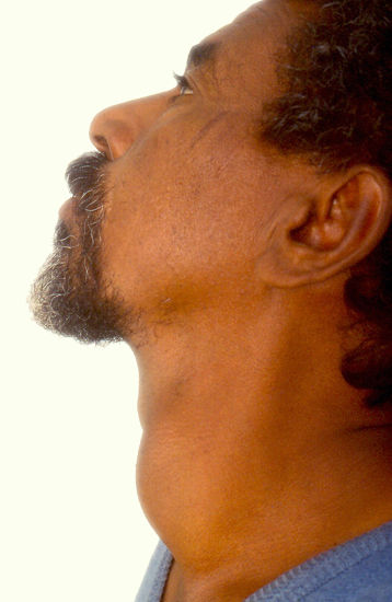 Patient Has Multinodular Goitre Swelling Neck Editorial Stock Photo ...
