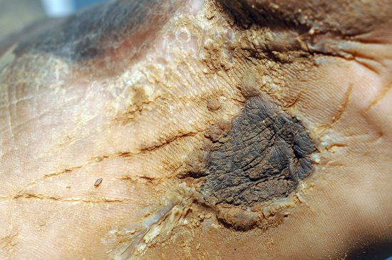 Left Foot Mycetoma Exercised Skin Graft Editorial Stock Photo - Stock ...