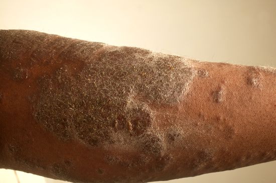 Arm Unknown Skin Lesion Editorial Stock Photo - Stock Image | Shutterstock