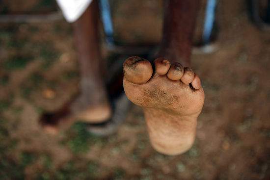 Feet Young Man Suffering Leprosy Leprosy Editorial Stock Photo - Stock ...