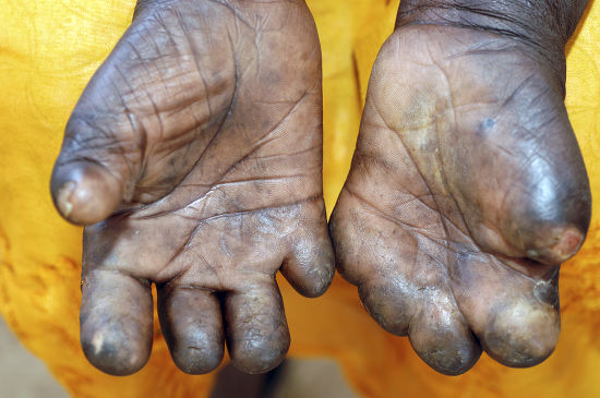 Elderly Female Leper Wearing Yellow Sari Editorial Stock Photo - Stock ...