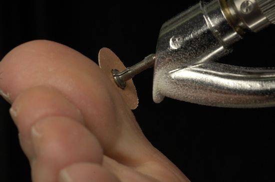 Podiatrist Uses Rotary Tool Remove Calluses Editorial Stock Photo ...