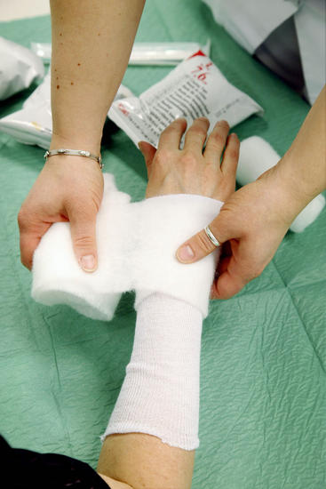Broken Arm Put Plaster Cast Mehilainen Editorial Stock Photo - Stock ...
