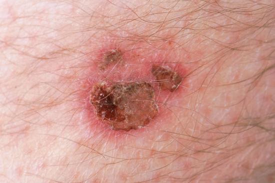 Scabbed Wound On Skin Editorial Stock Photo - Stock Image | Shutterstock