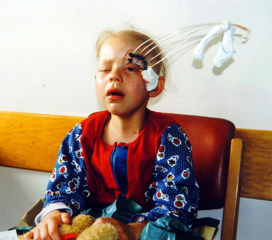 Katharina Esser Aged Three During Treatment Editorial Stock Photo ...