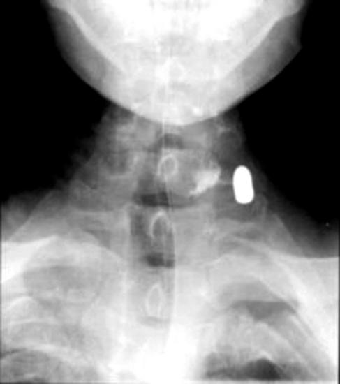 Xray Bullet Neck Abu Kamara Who Editorial Stock Photo - Stock Image ...