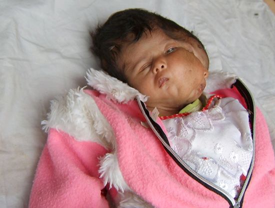 Baby Lali Who Born Two Faces Editorial Stock Photo - Stock Image ...