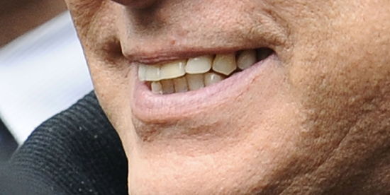 Close Repaired Teeth Italian Premier Silvio Editorial Stock Photo ...