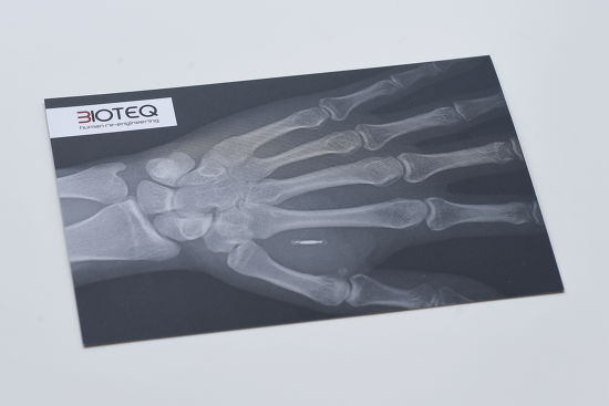 Xray Showing Microchip Implanted Hand Editorial Stock Photo - Stock ...