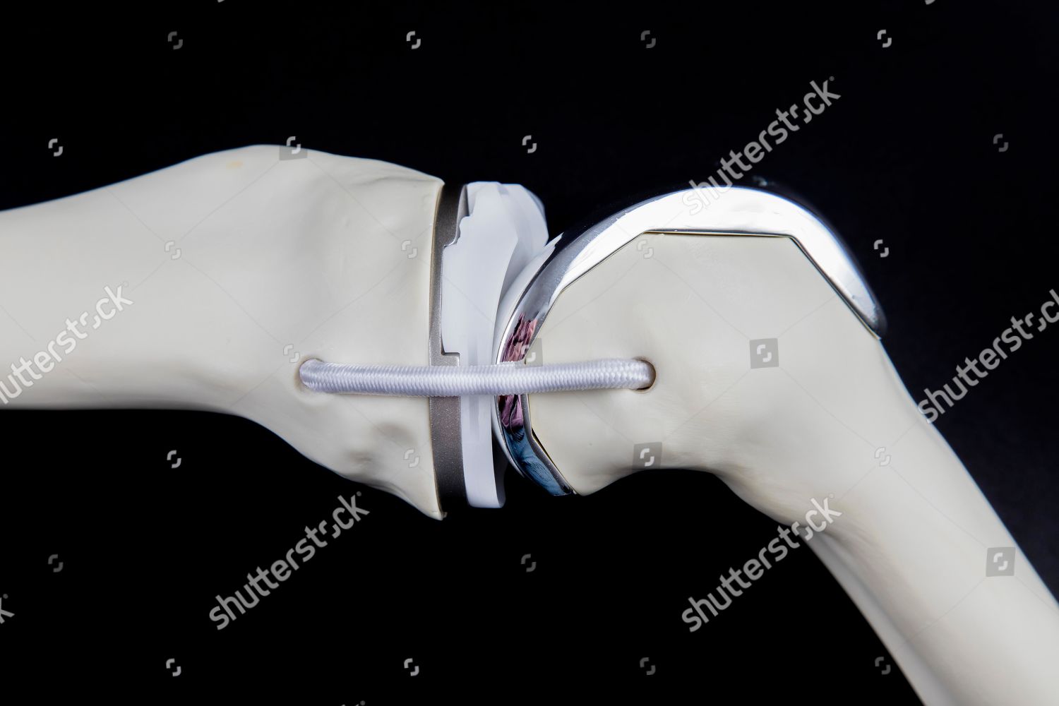 Knee Prosthesis Knee Endoprosthesis Knee Joint Editorial Stock Photo ...