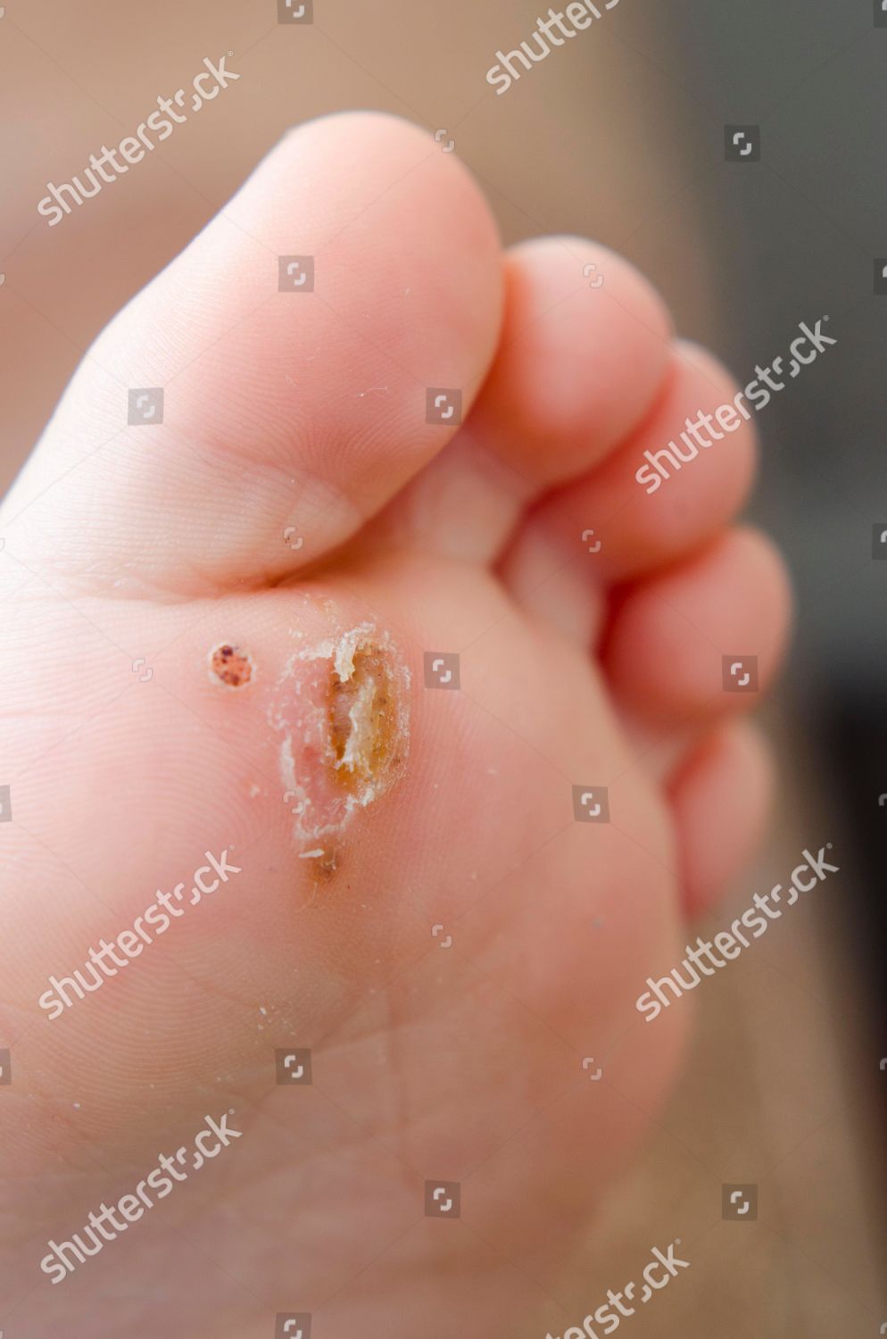 Verruca Plantar Wart On Childs Foot Editorial Stock Photo - Stock Image ...