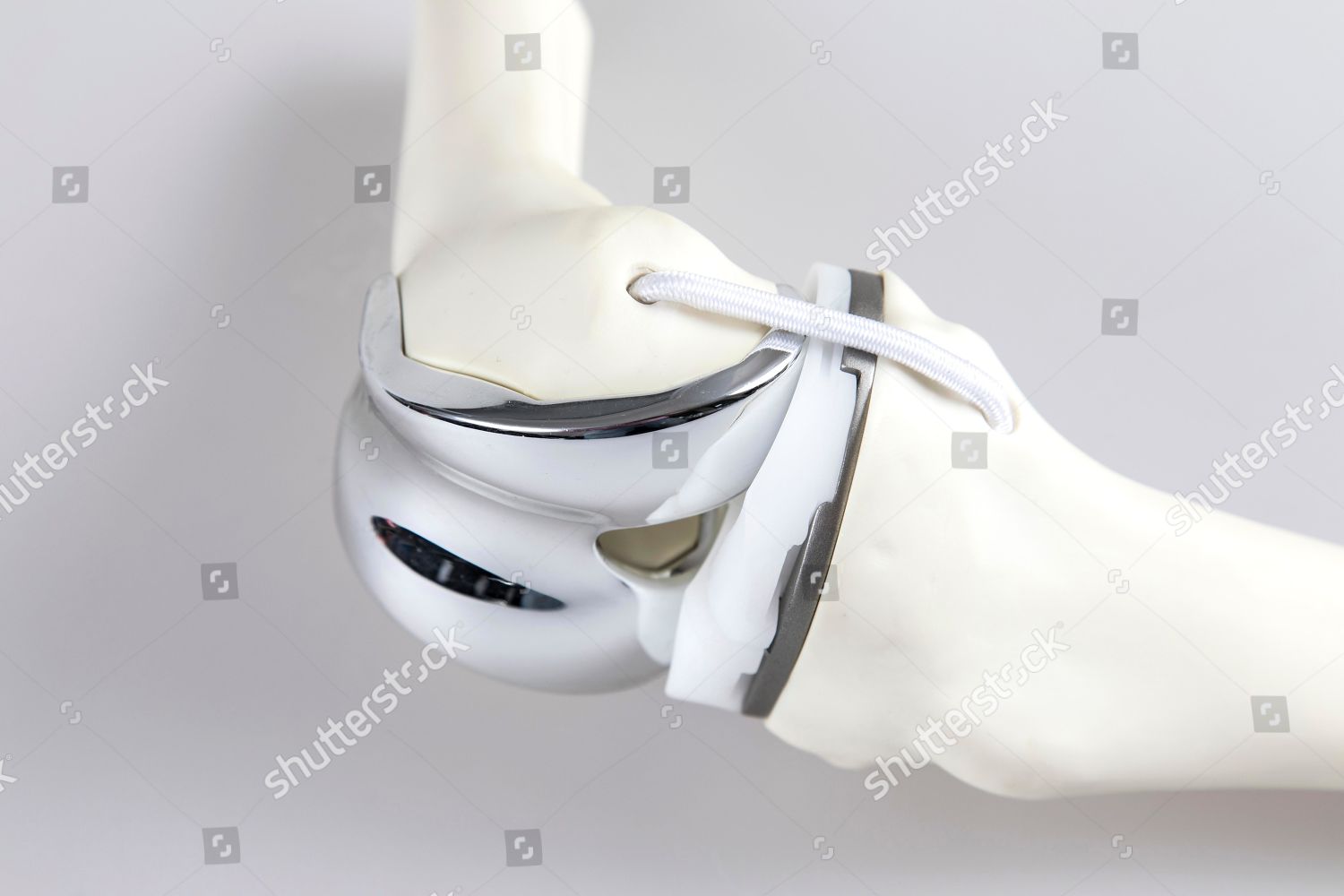 Knee Prosthesis Knee Endoprosthesis Knee Joint Editorial Stock Photo ...