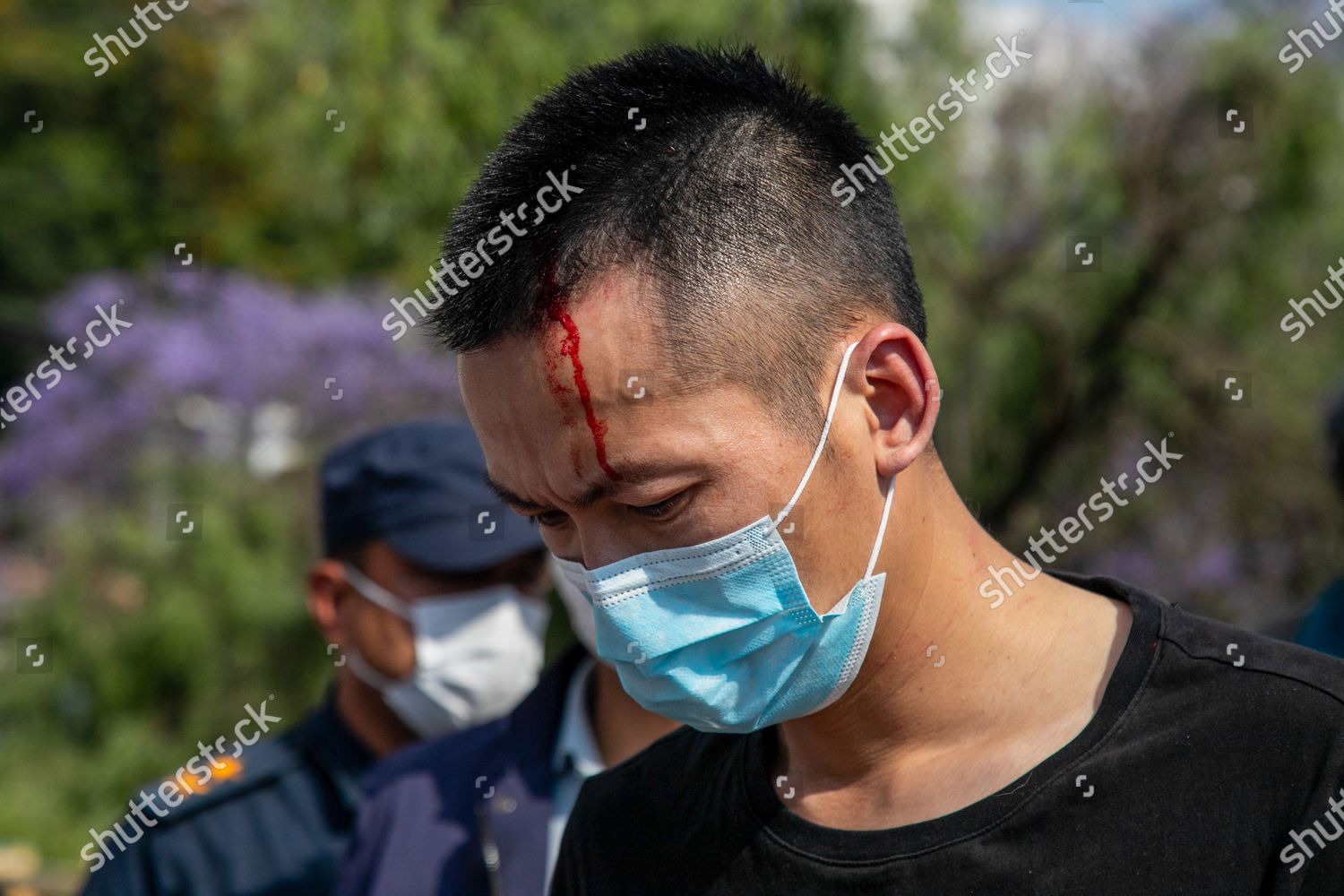 Man Bleeding Wound On Face Wears Editorial Stock Photo - Stock Image ...