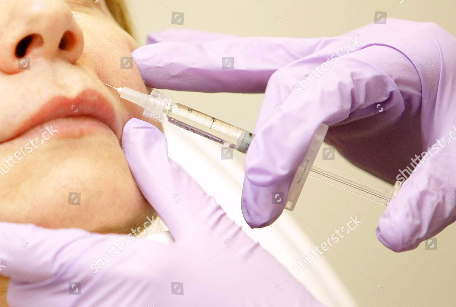 Woman Receiving Botox Injections Into Areas Editorial Stock Photo ...