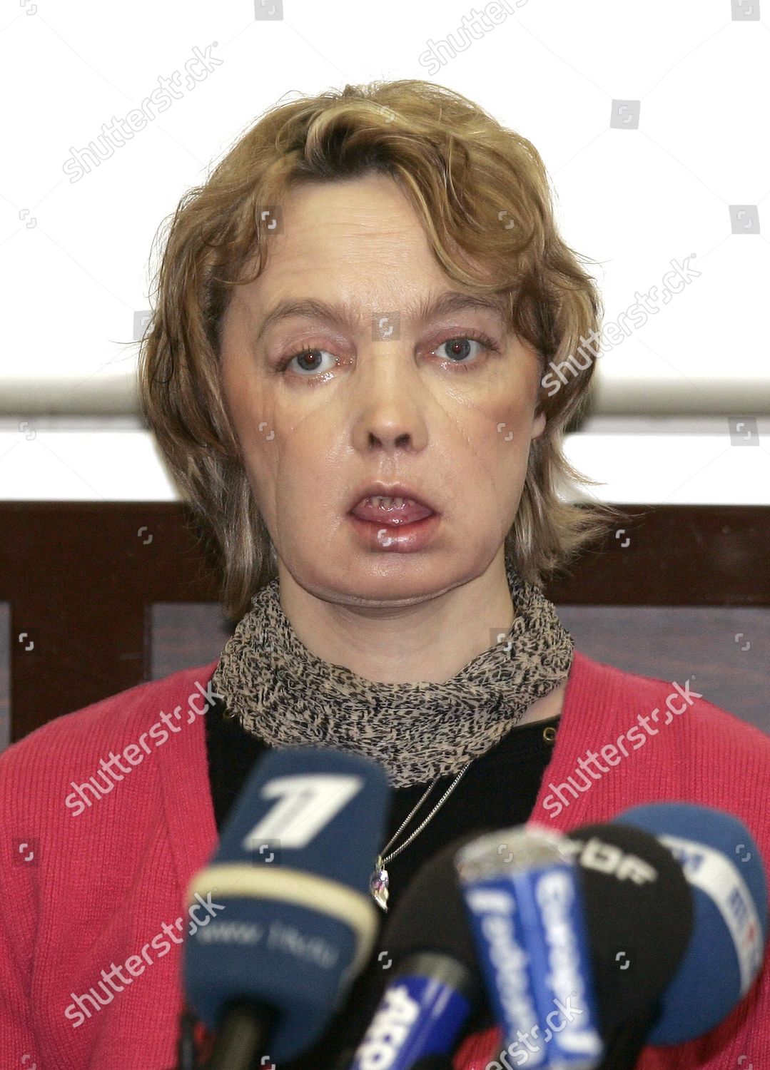Isabelle Dinoire French Woman Who Received Editorial Stock Photo ...