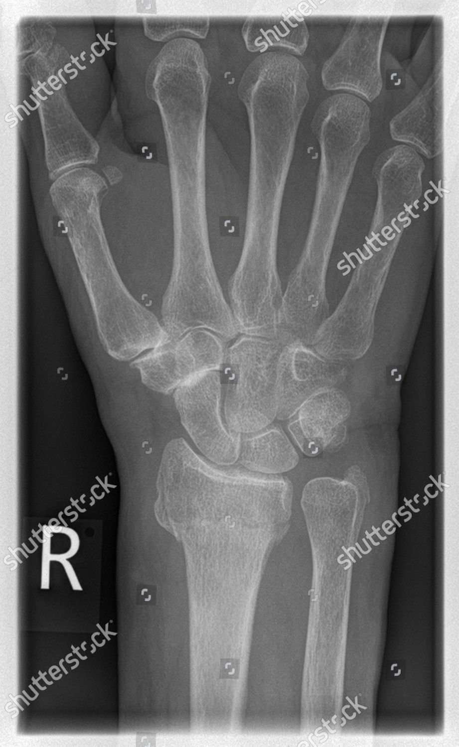 Xray Patient Distal Radial Extension Fracture Editorial Stock Photo ...
