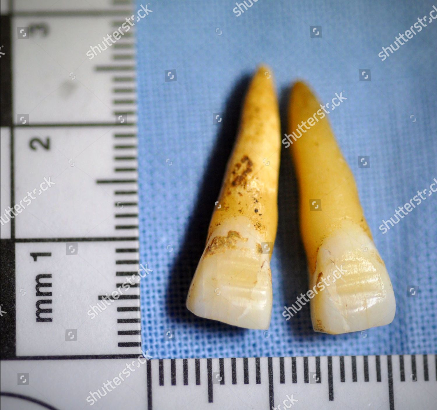 Teeth Featuring Horizontal Grooves Recovered Mass Editorial Stock Photo ...