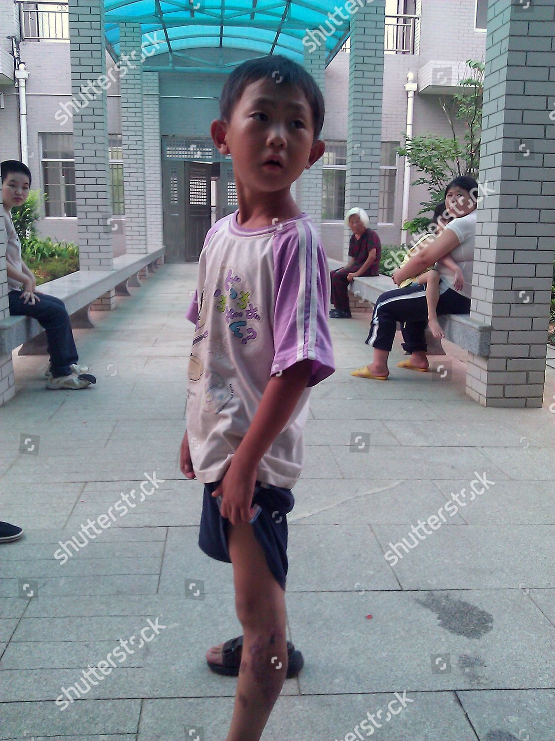 Little Boy Shows Off Scars On Editorial Stock Photo - Stock Image ...
