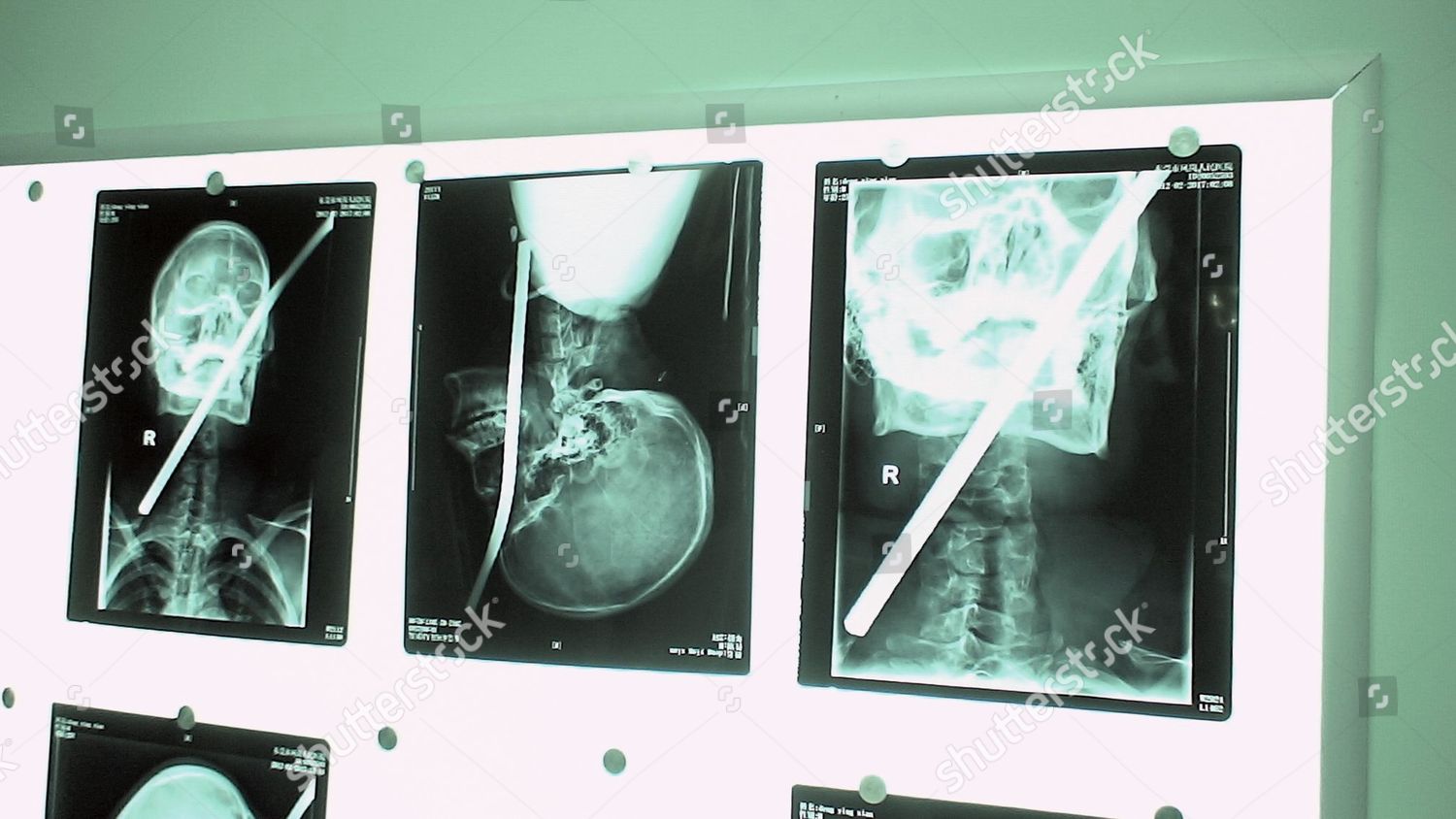 Xrays Showing Bar Impaled Through Mans Editorial Stock Photo - Stock ...