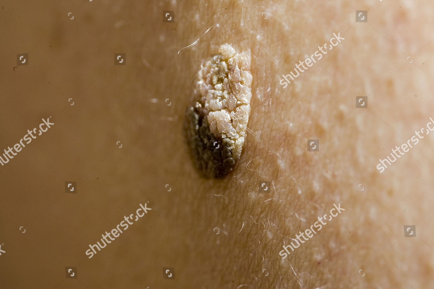 Common Wart Verruca Senilis Editorial Stock Photo - Stock Image ...