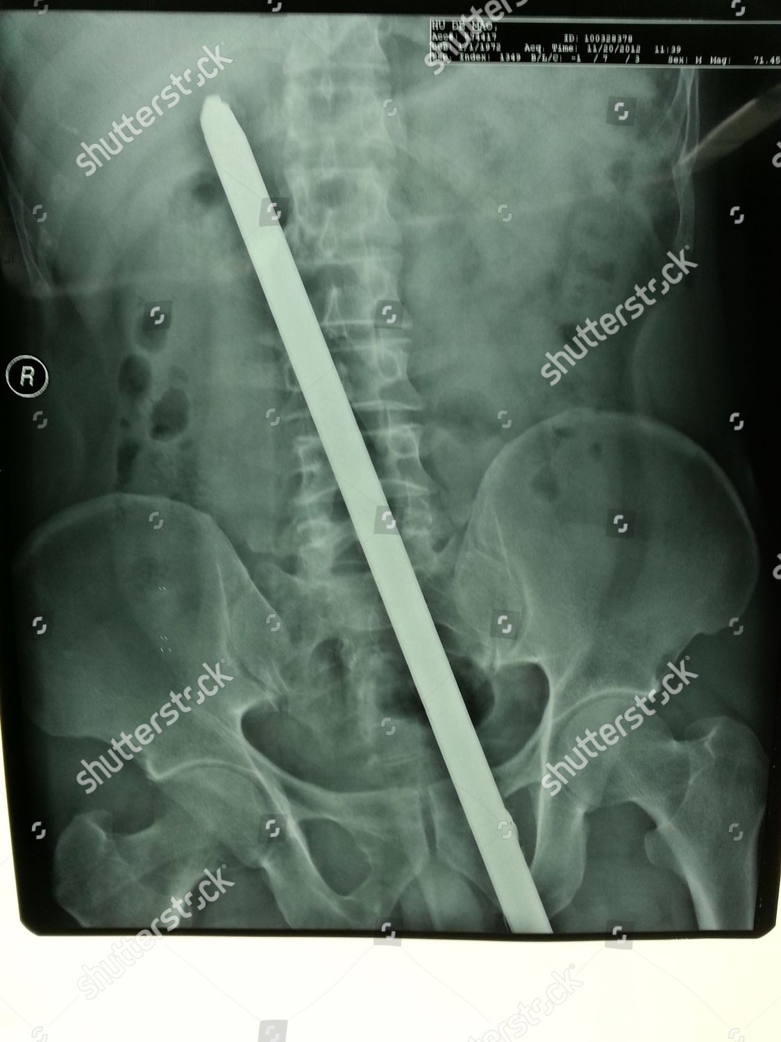Xray Showing Bar Impaled Through Hu Editorial Stock Photo - Stock Image ...