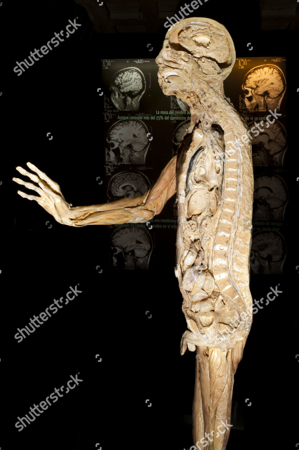 Plastination Specimen Half Human Body Without Editorial Stock Photo ...