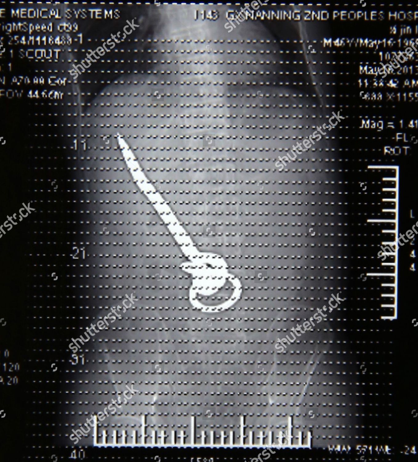 Xray Showing Lao Xi Nail Impaled Editorial Stock Photo - Stock Image ...