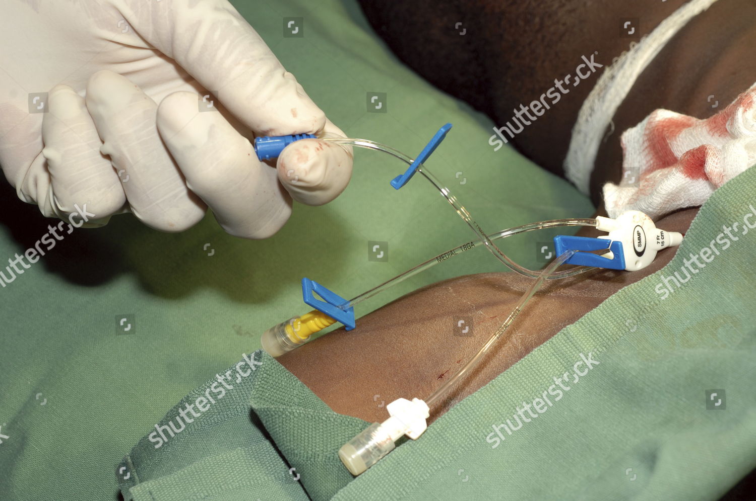 Central Venous Catheter Insertion Editorial Stock Photo - Stock Image ...