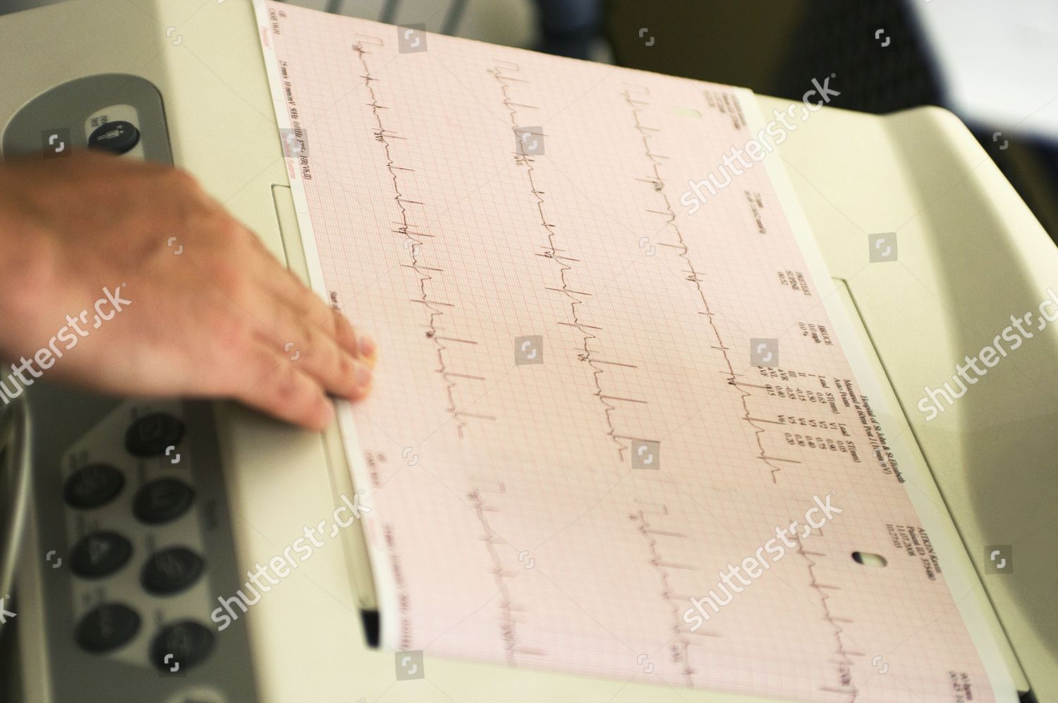 Electrocardiogram Recording Patients Cardiac Cycle Editorial Stock ...