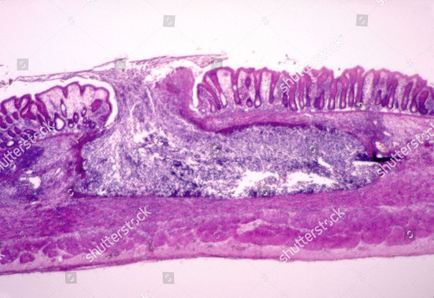 Amibiasis Editorial Stock Photo - Stock Image | Shutterstock
