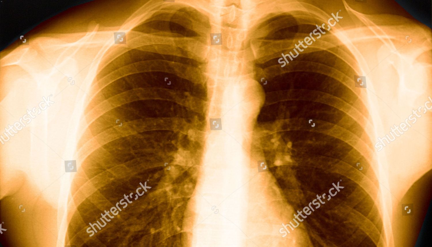 Thorax X Ray Editorial Stock Photo - Stock Image | Shutterstock