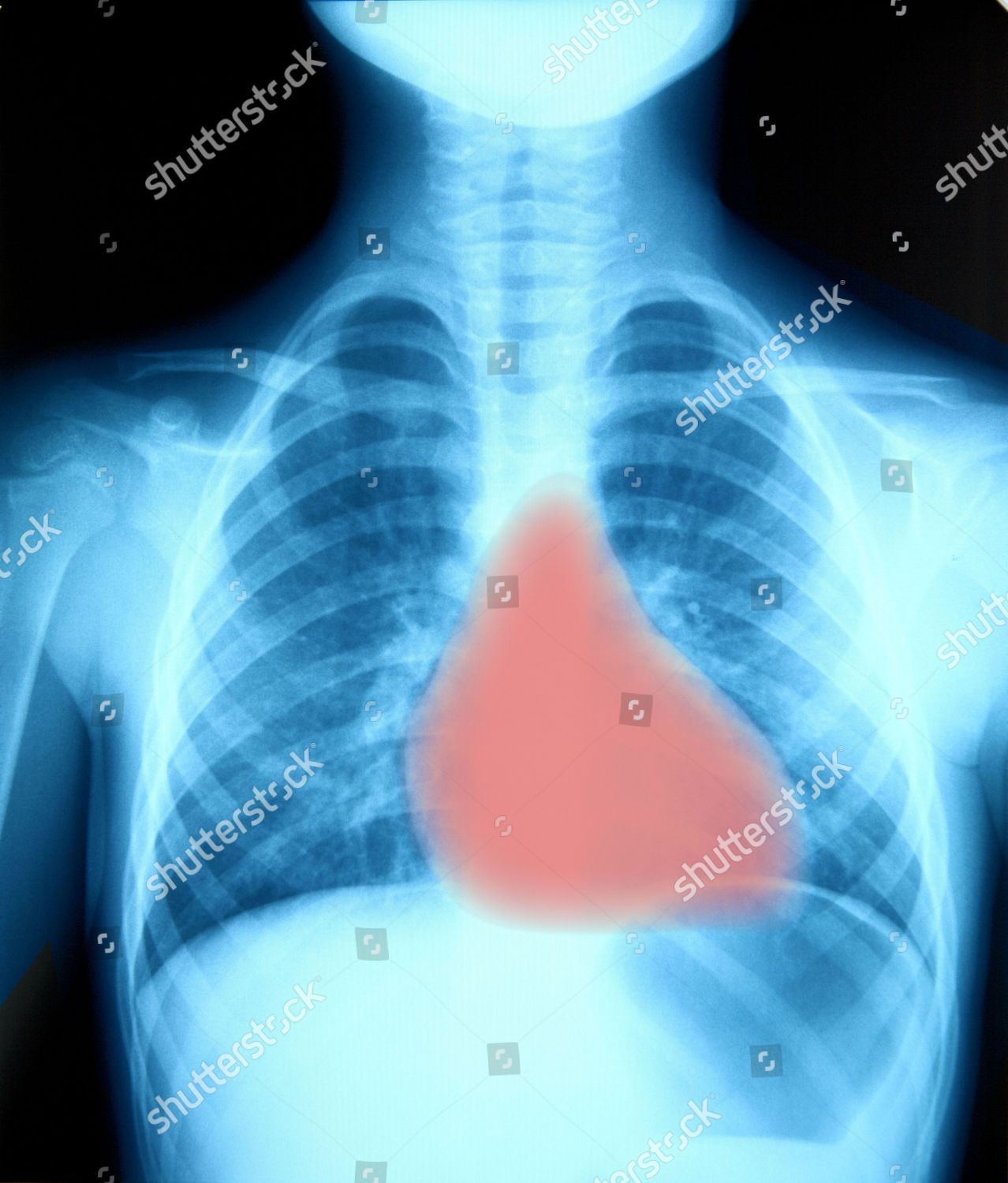 Thorax X Ray Editorial Stock Photo - Stock Image | Shutterstock