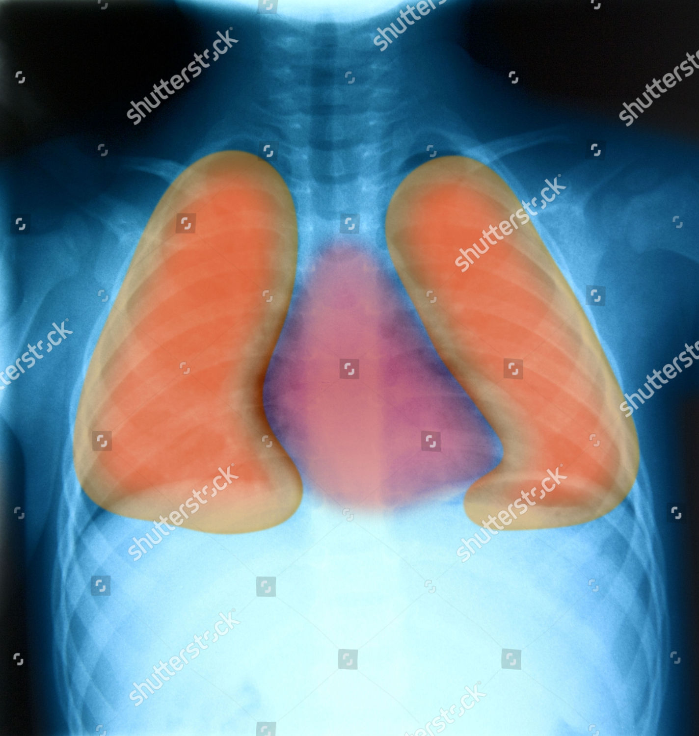 Thorax X Ray Editorial Stock Photo - Stock Image | Shutterstock