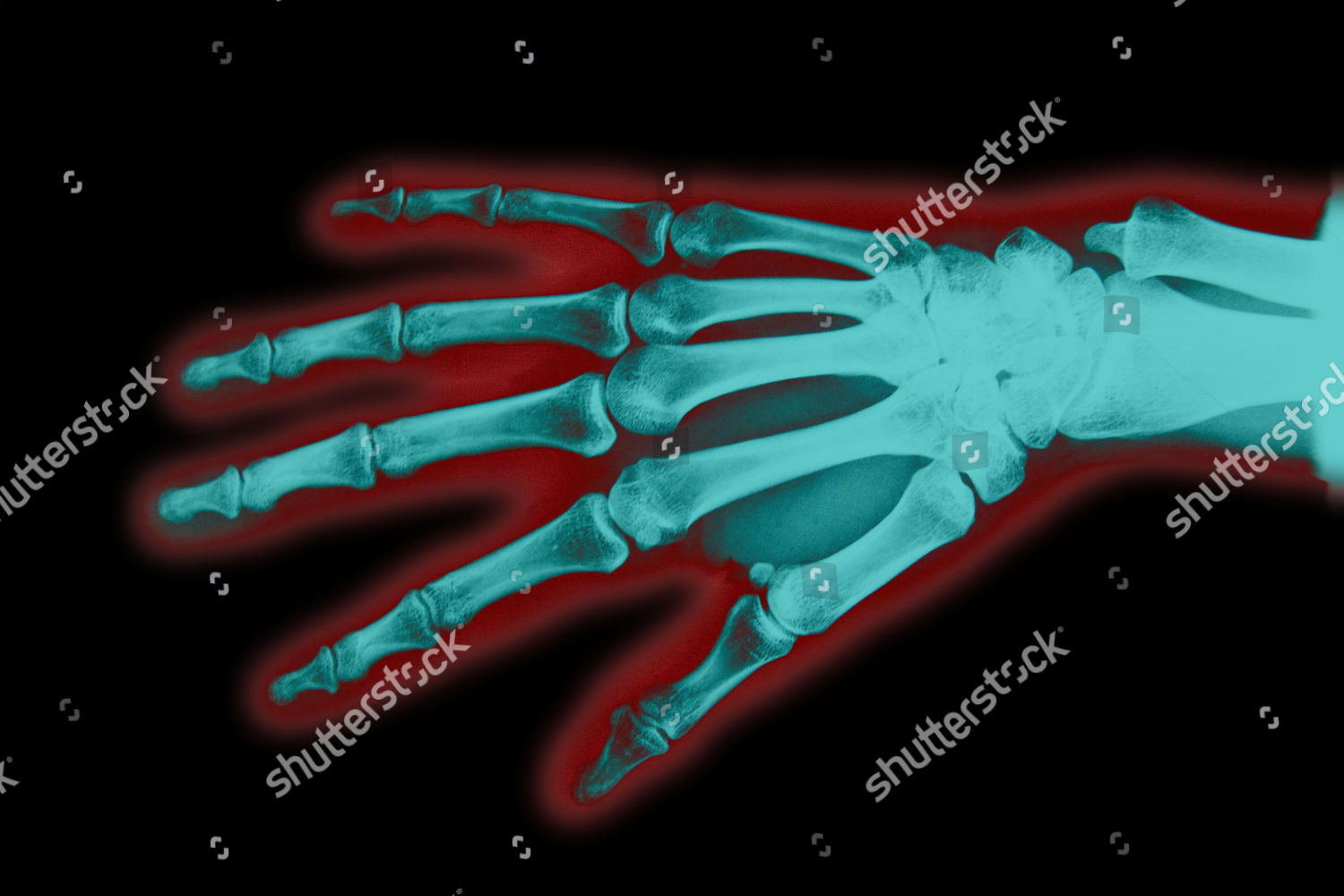 Hand X Ray Editorial Stock Photo - Stock Image | Shutterstock