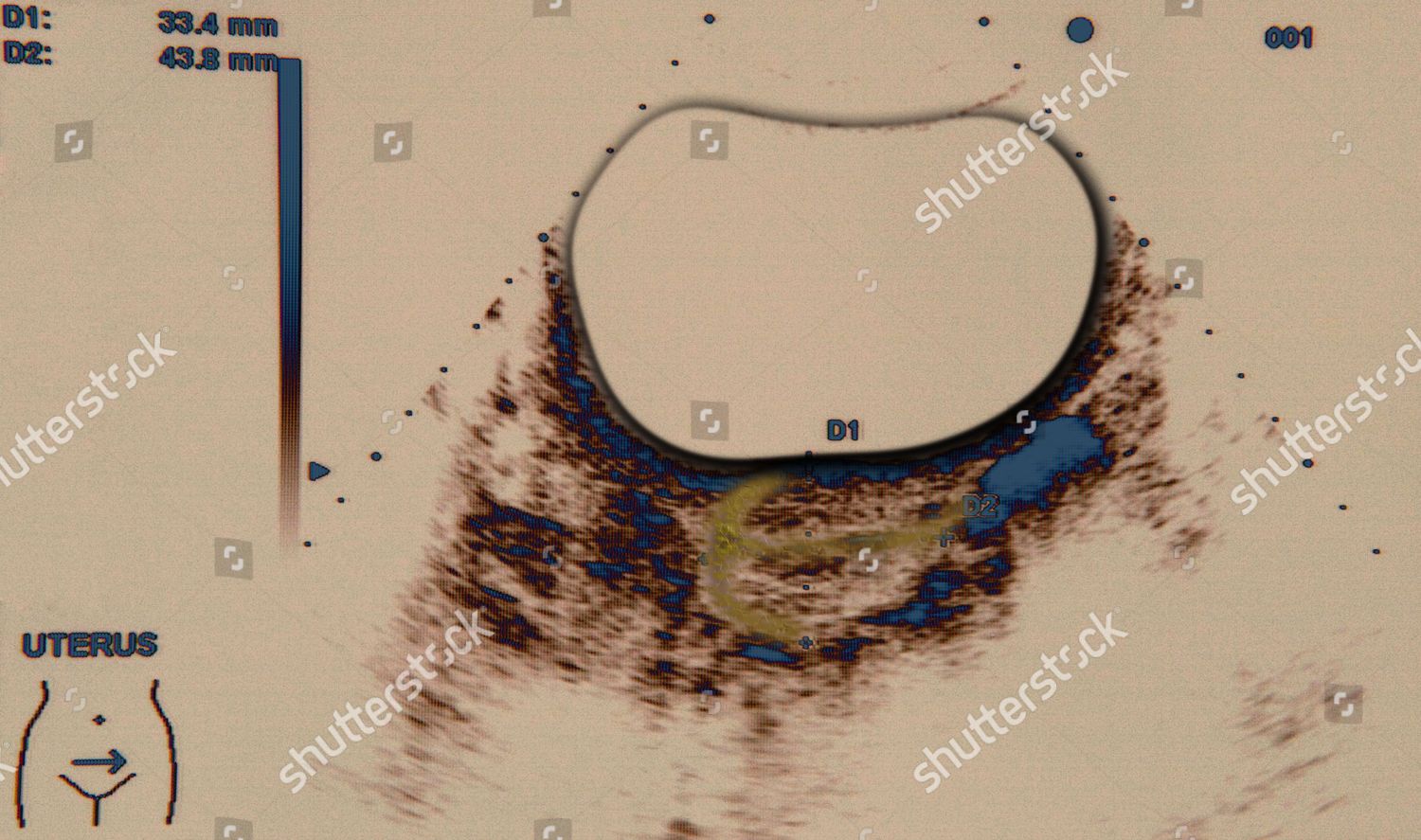 Pelvic Ultrasound Editorial Stock Photo - Stock Image | Shutterstock
