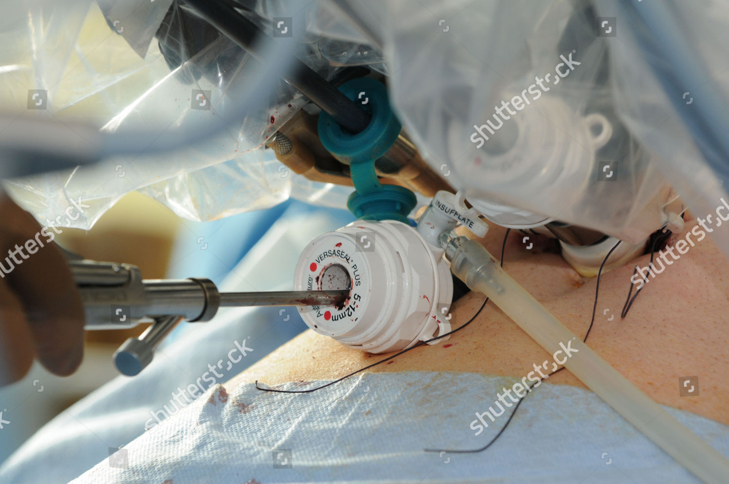 Prostatectomy Editorial Stock Photo - Stock Image | Shutterstock